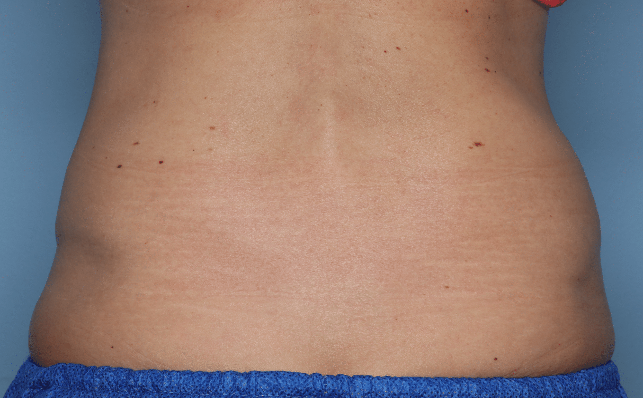 CoolSculpting - Flanks - Farrell Laser & Aesthetic Medicine Center