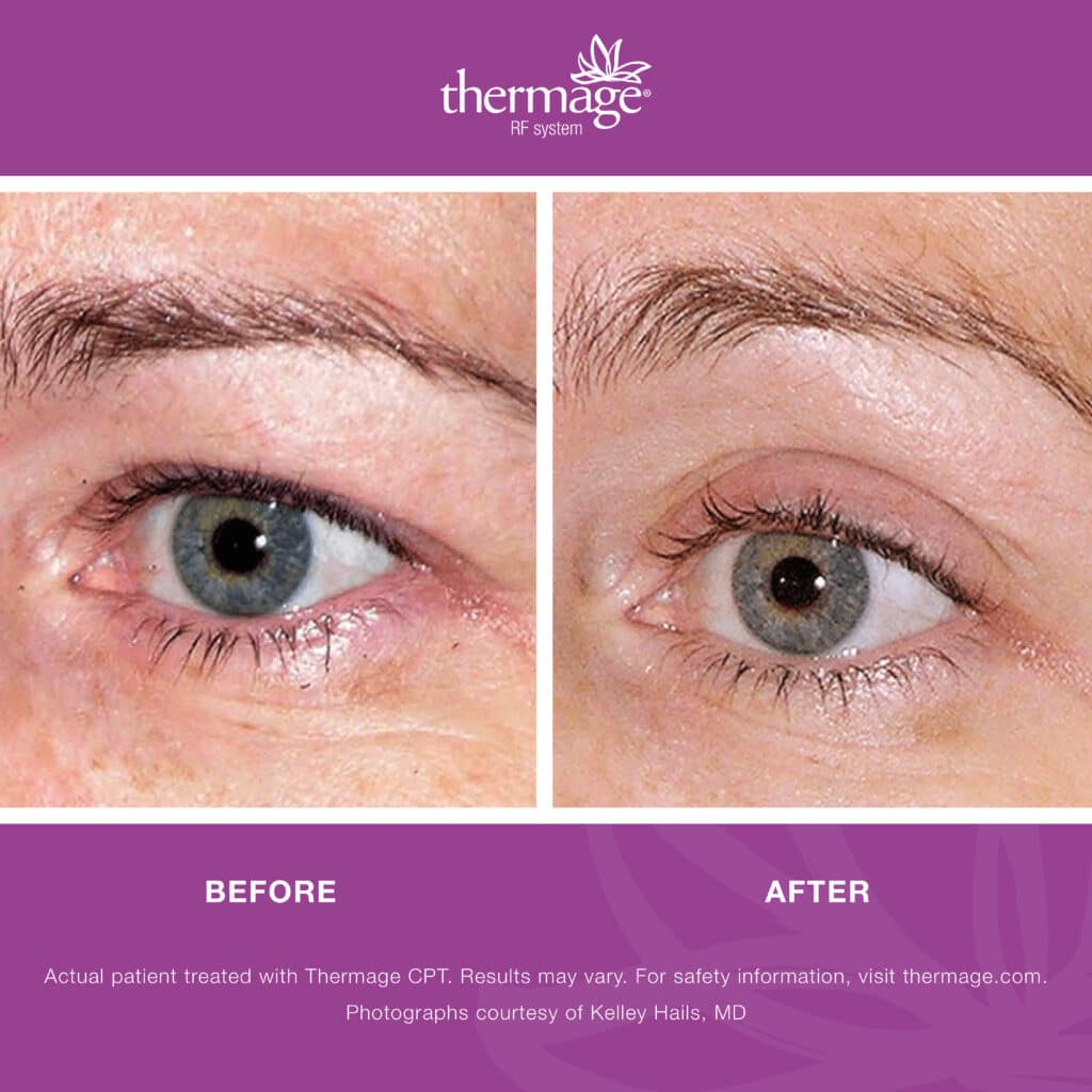 Thermage Mechanicsburg PA - Radiofrequency Skin Tightening