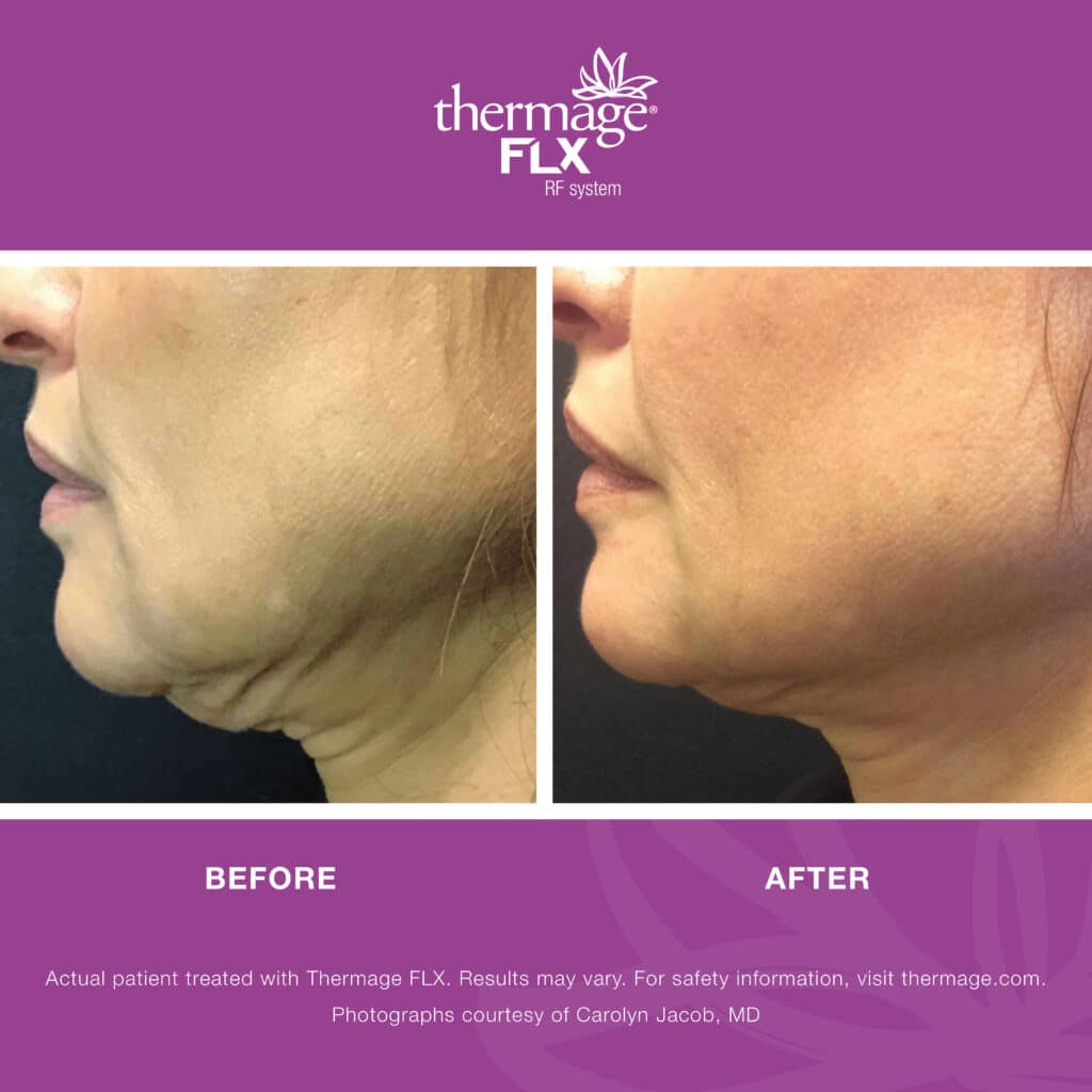 Thermage Mechanicsburg PA - Radiofrequency Skin Tightening