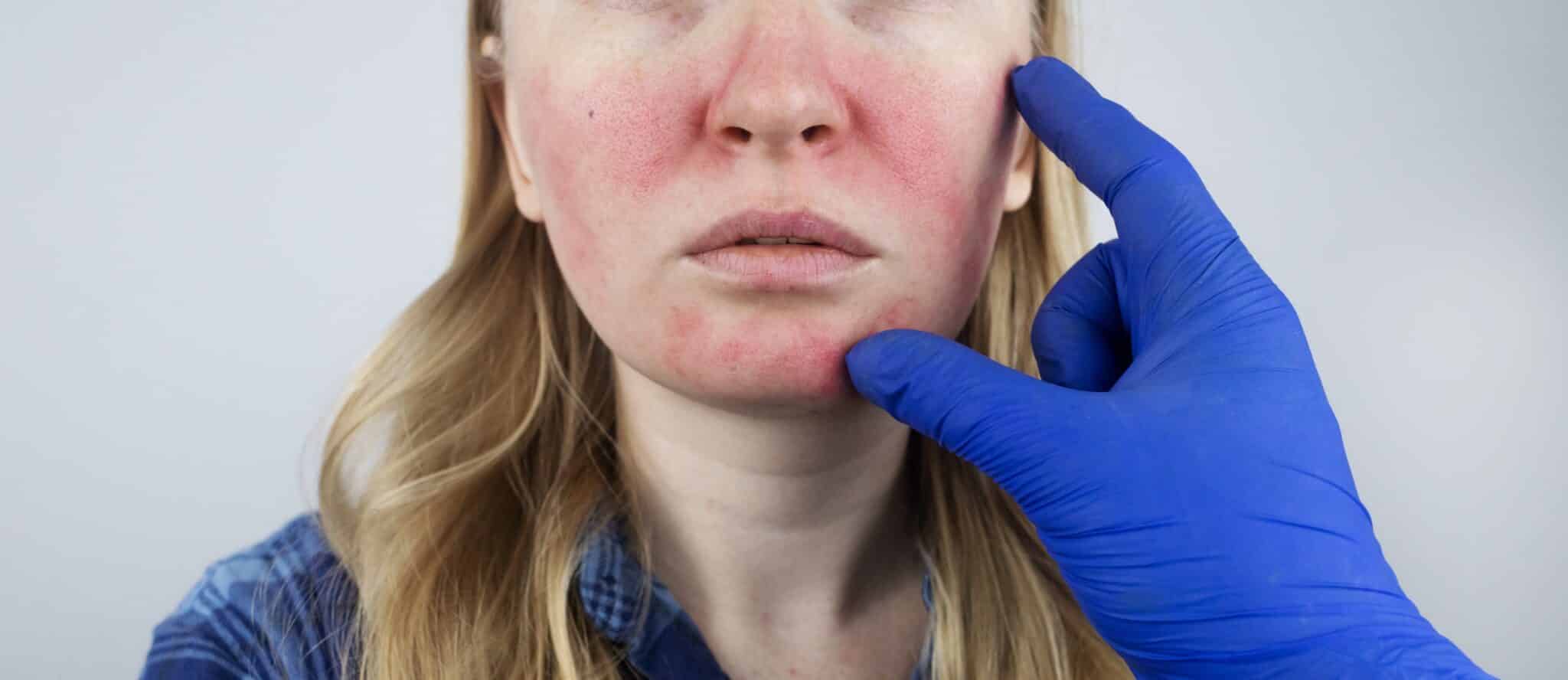 How Vbeam® Laser Treatment Helps Rosacea Mechanicsburg PA